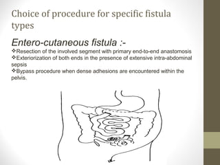 Enterocutaneous fistulas | PPT