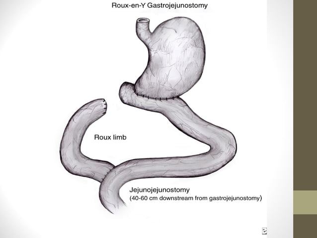 Enterocutaneous fistulas
