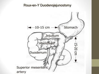 Enterocutaneous Fistula Diagram