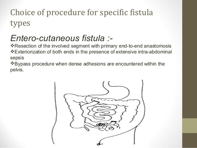 Enterocutaneous fistulas