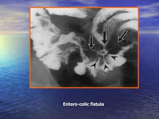 Entero Cutaneous Fistula by Dr. Onkar | PPT
