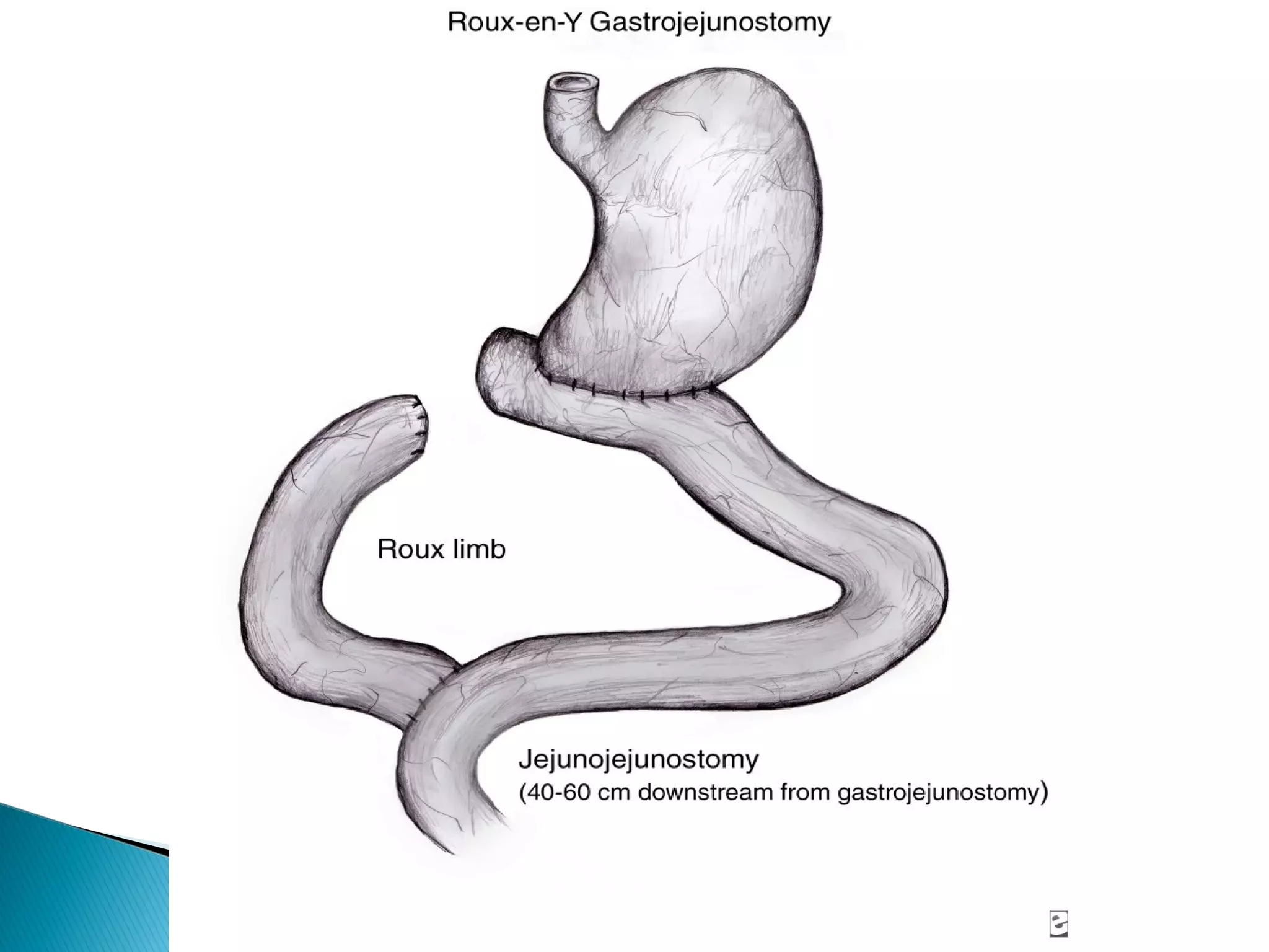Entero cutaneous fistula | PPT
