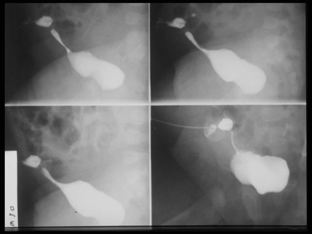 Entero cutaneous fistula | PPT