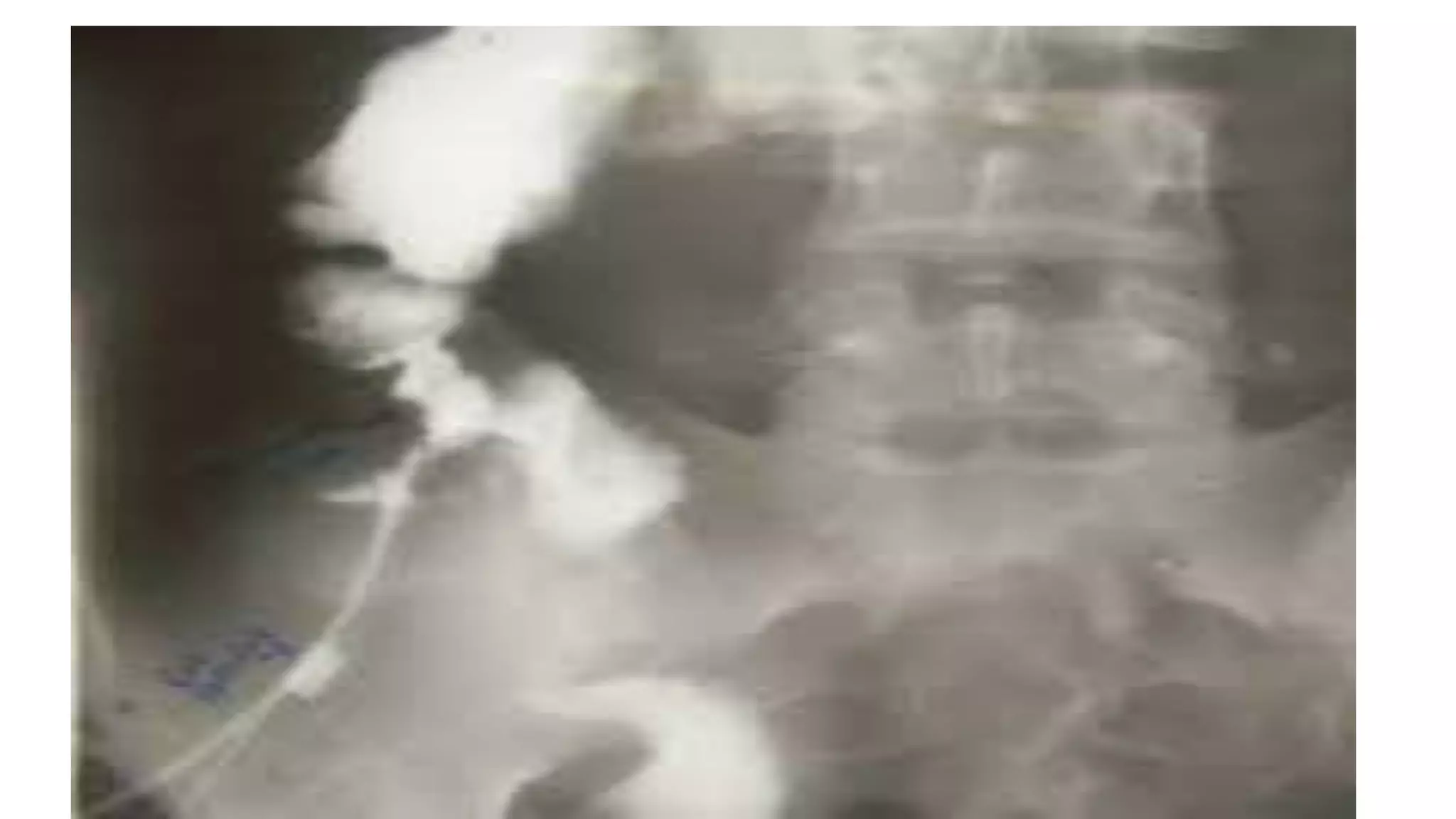 Enterocutaneous fistula.pptx