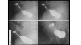 Enterocutaneous fistula.pptx