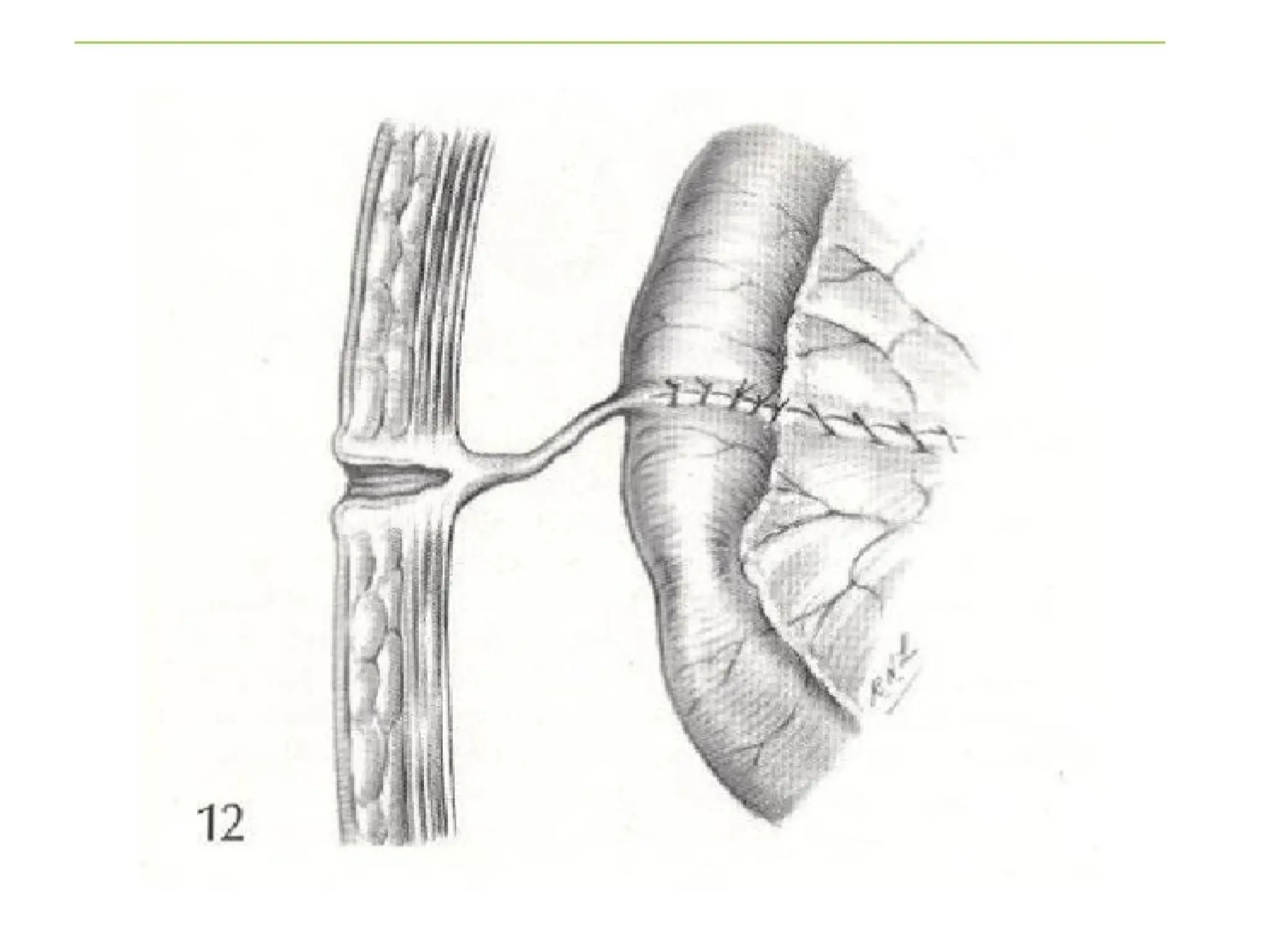 ENTEROCUTANEOUS FISTULA diagnosis and management | PPTX