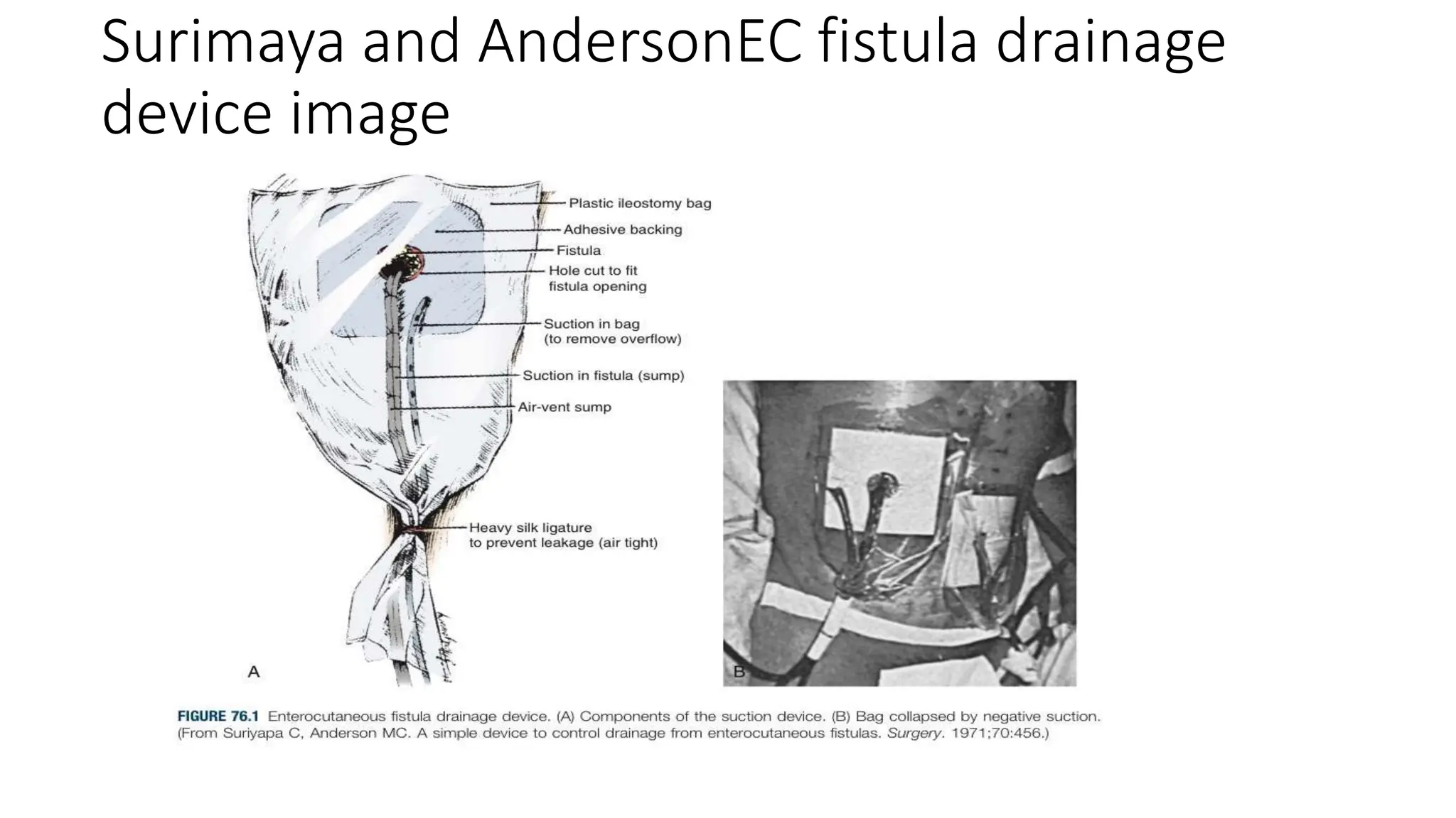 Enterocutaneous fistula fecal fistula neo.pptx
