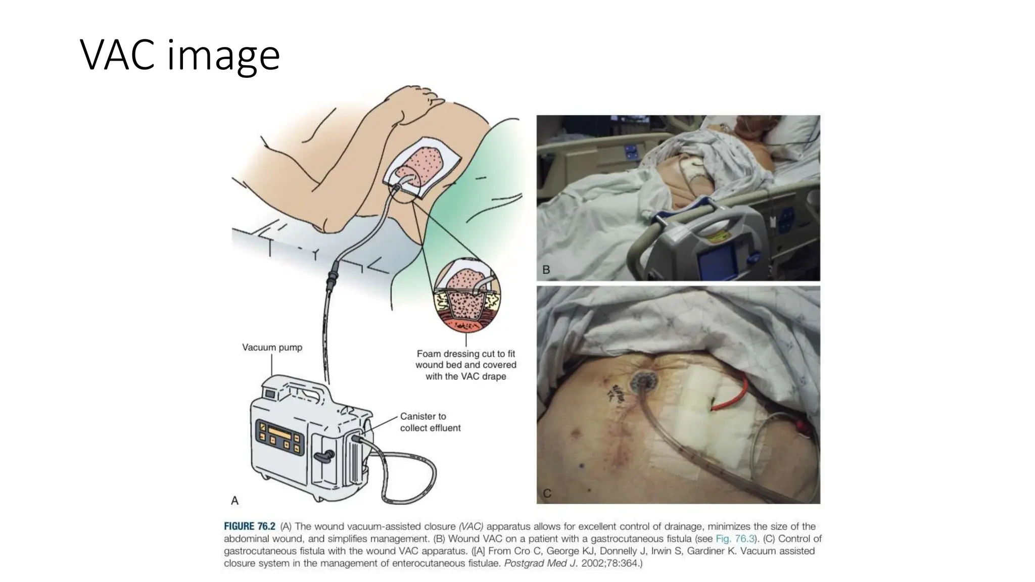 Enterocutaneous fistula fecal fistula neo.pptx