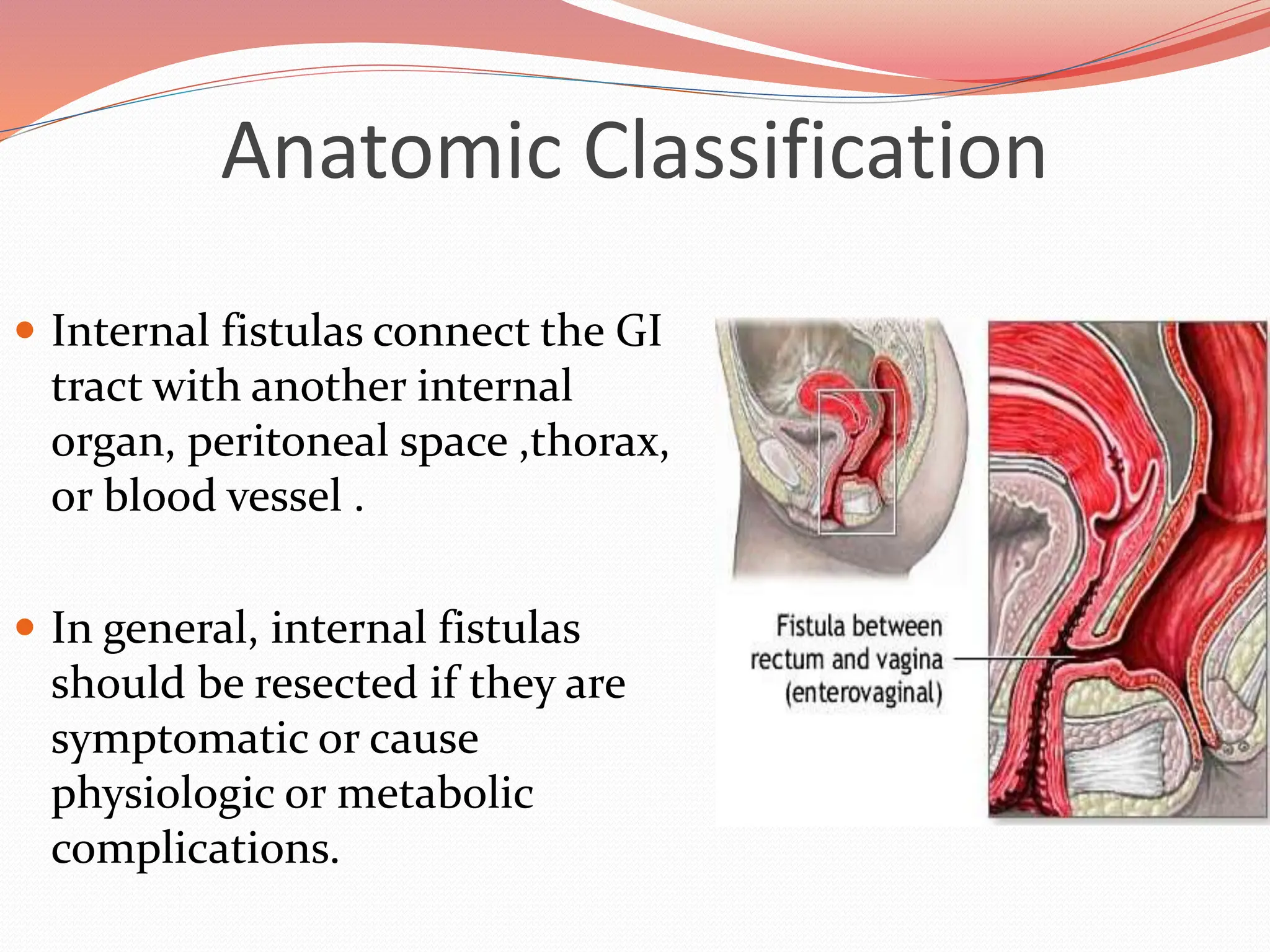 Enterocutaneous Fistula (general surg).pptx