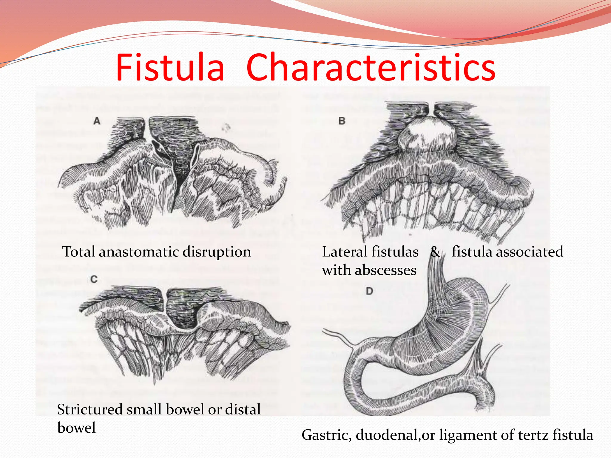 Enterocutaneous Fistula (general surg).pptx