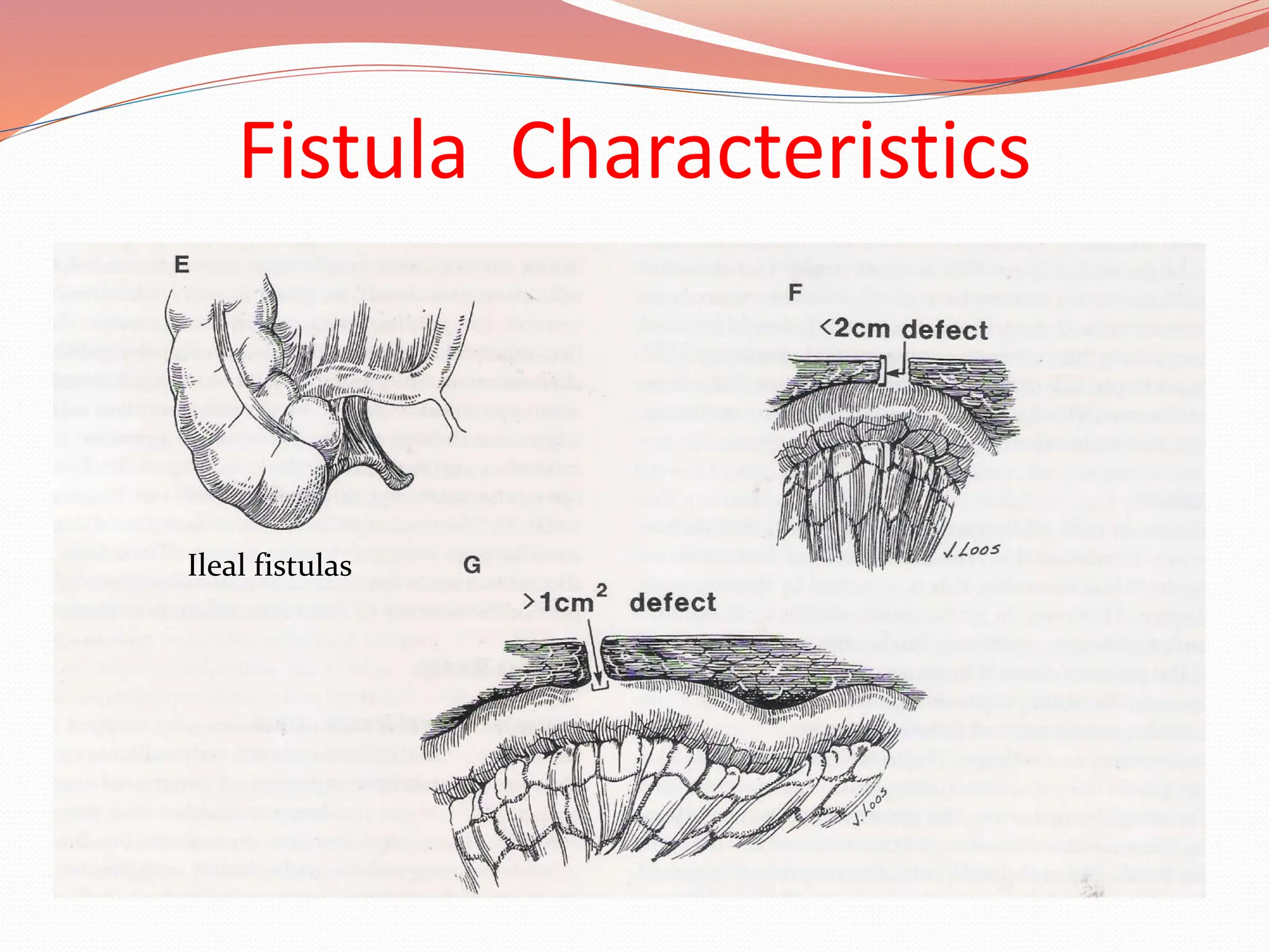 Enterocutaneous Fistula (general surg).pptx | Digestive Disorders | Diseases and Conditions