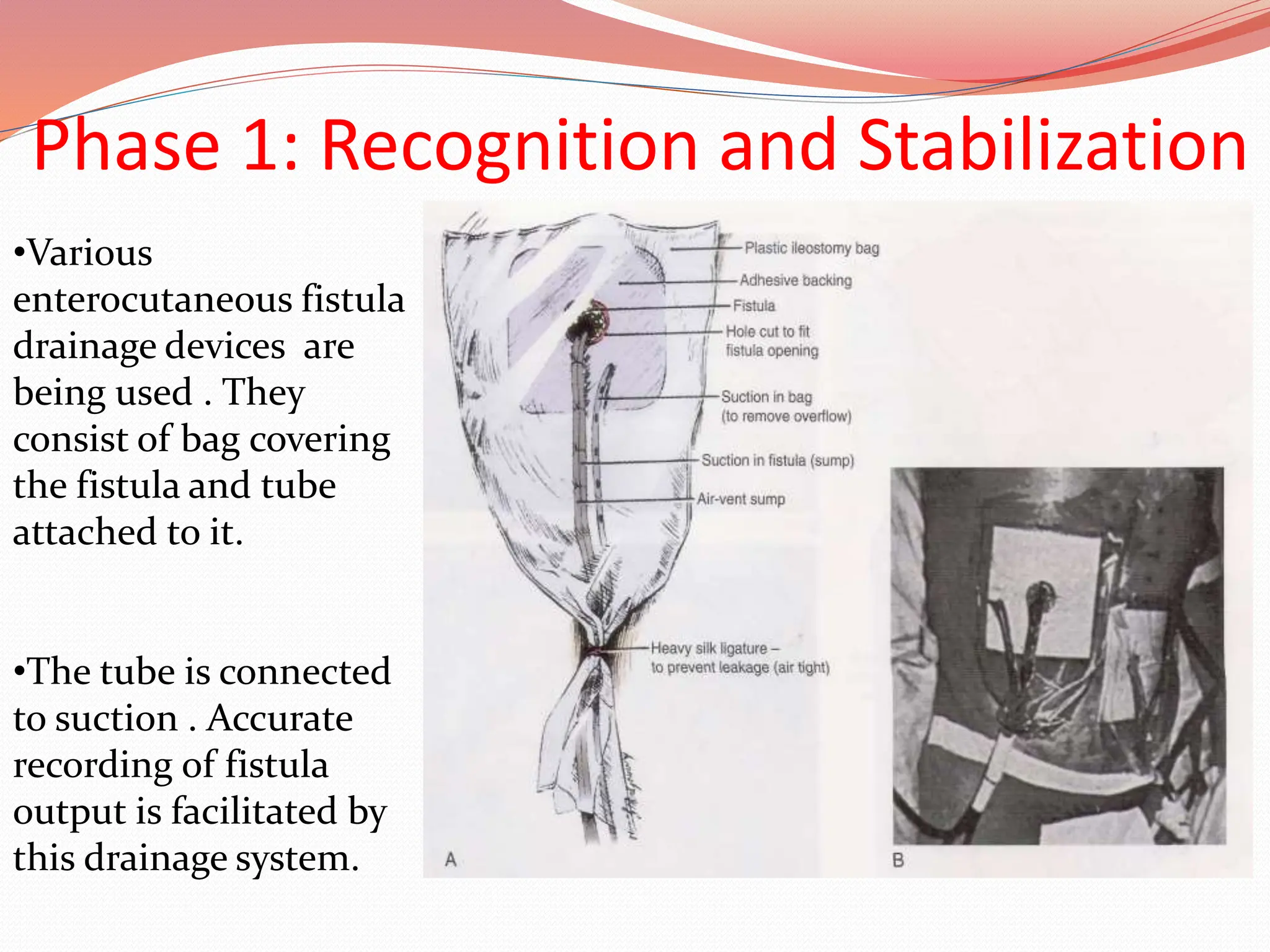 Enterocutaneous Fistula (general surg).pptx