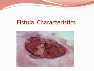 Enterocutaneous Fistula (general surg).pptx