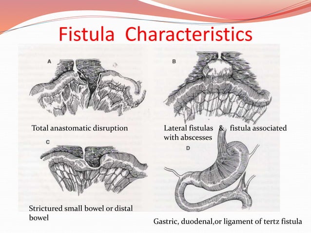 Enterocutaneous Fistula (general surg).pptx | Digestive Disorders ...