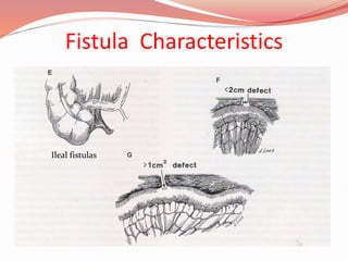 Enterocutaneous Fistula (general surg).pptx