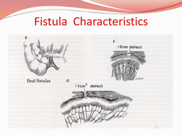 Enterocutaneous Fistula (general surg).pptx | Digestive Disorders | Diseases and Conditions