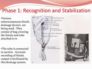 Enterocutaneous Fistula (general surg).pptx
