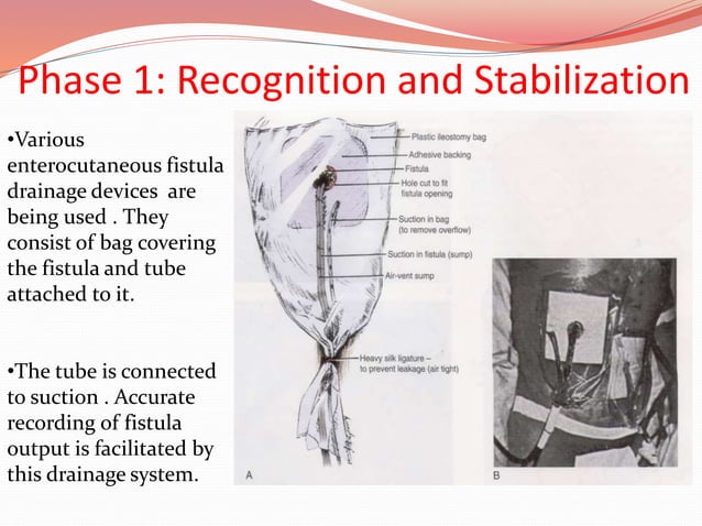 Enterocutaneous Fistula (general surg).pptx | Digestive Disorders ...