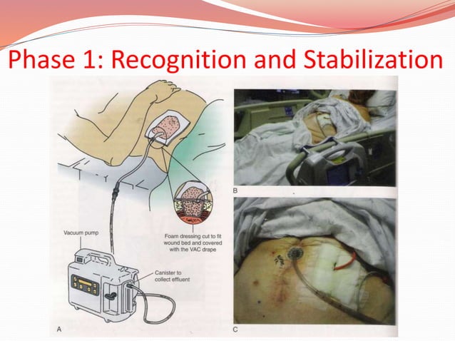 Enterocutaneous Fistula (general surg).pptx | Digestive Disorders ...