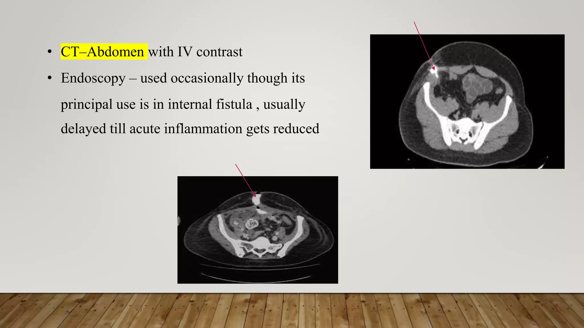 Enterocutanoeus fistula | PPTX