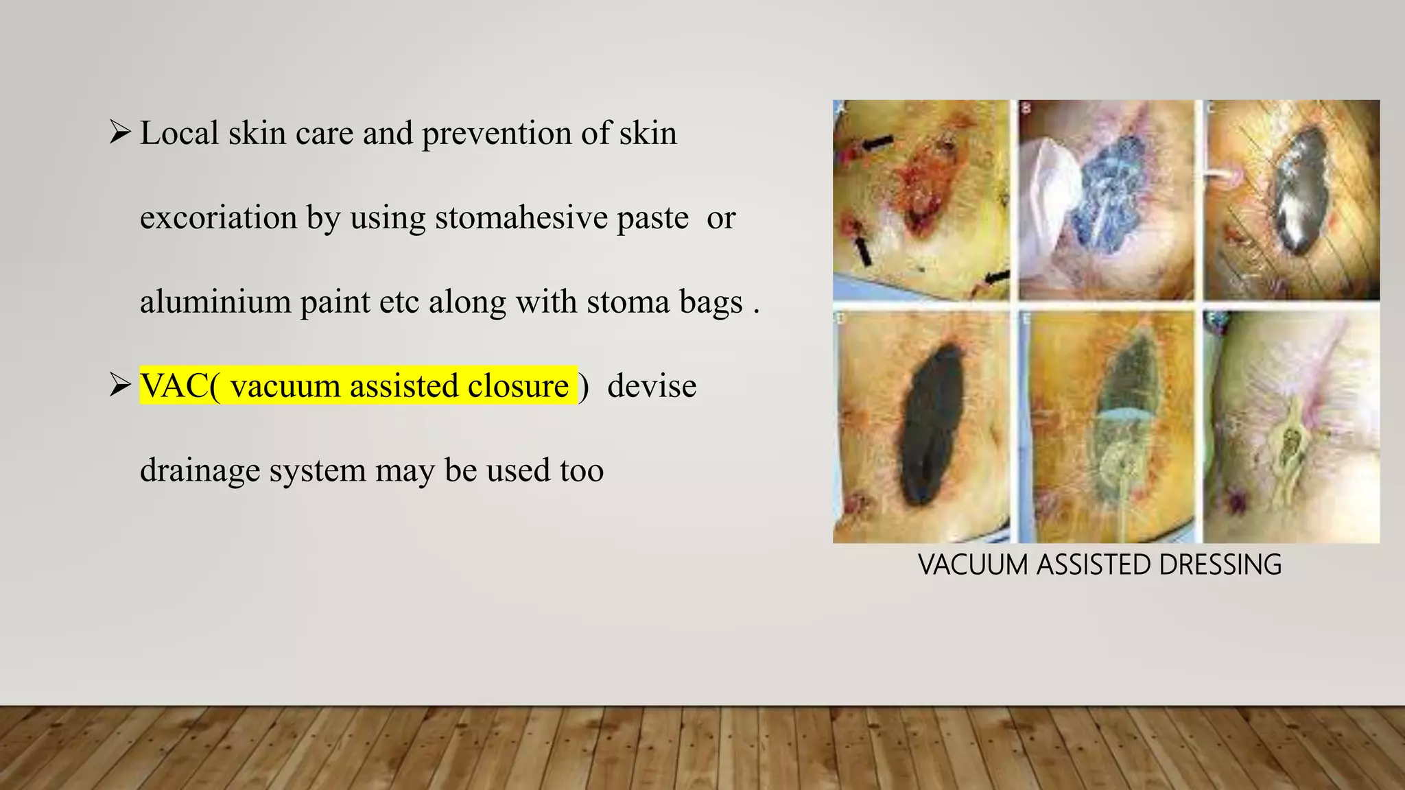 Enterocutanoeus fistula | PPTX