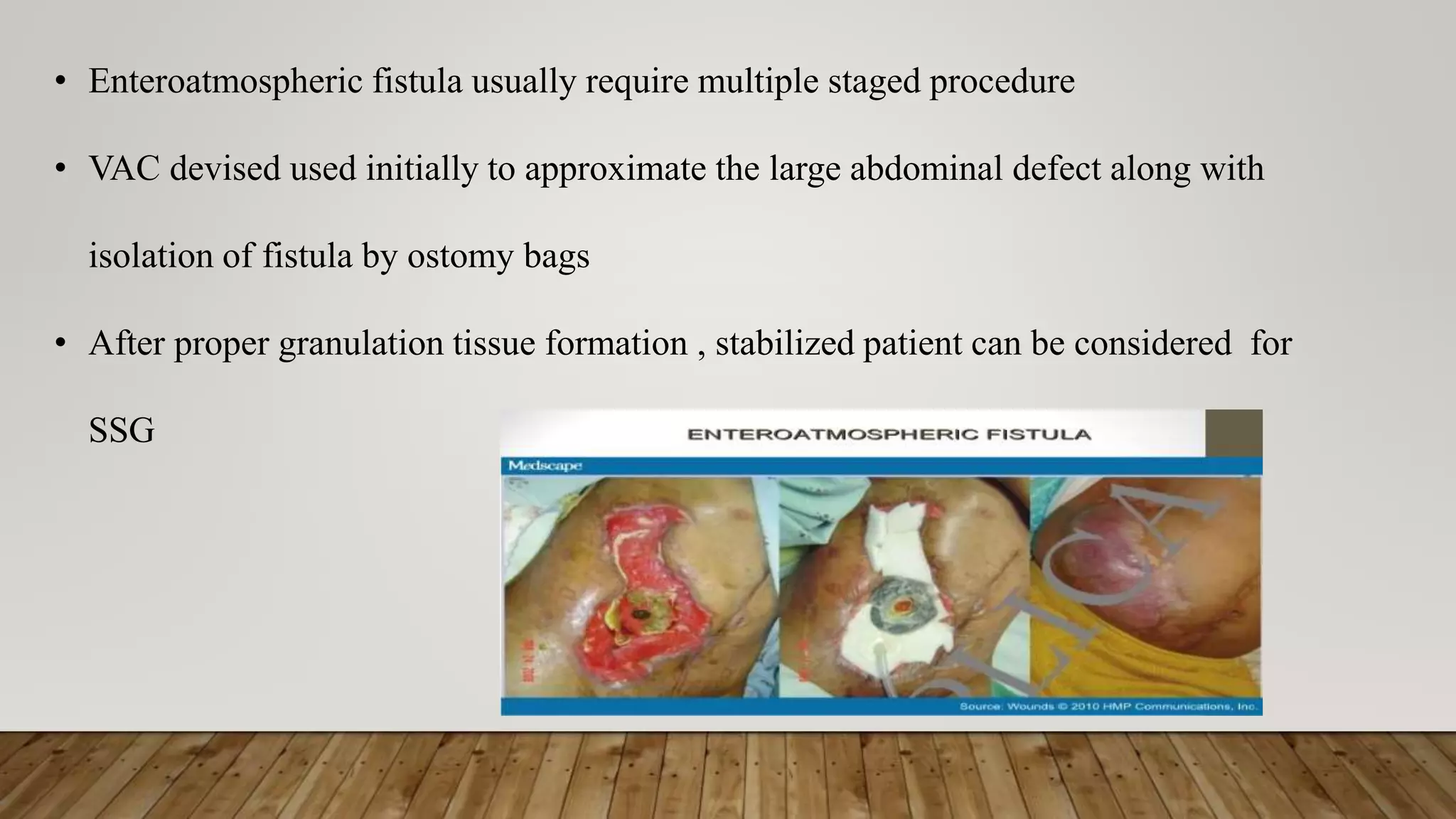 Enterocutanoeus fistula | PPTX
