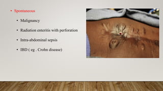 Enterocutanoeus fistula | PPTX