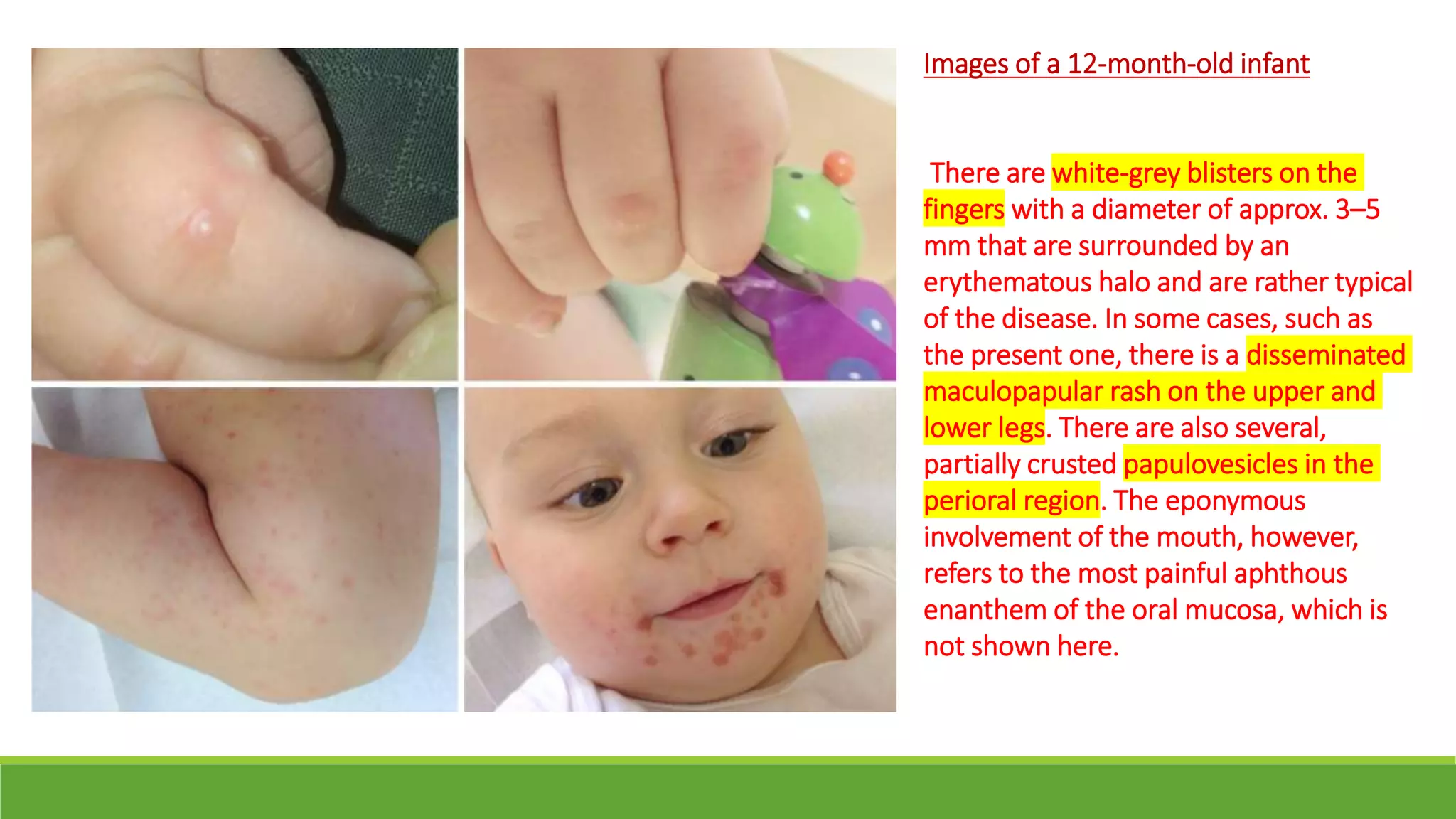 Enteroviruses ( Coxsackie & Echoviruses) | PPTX