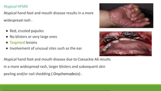 Enteroviruses ( Coxsackie & Echoviruses) | PPT