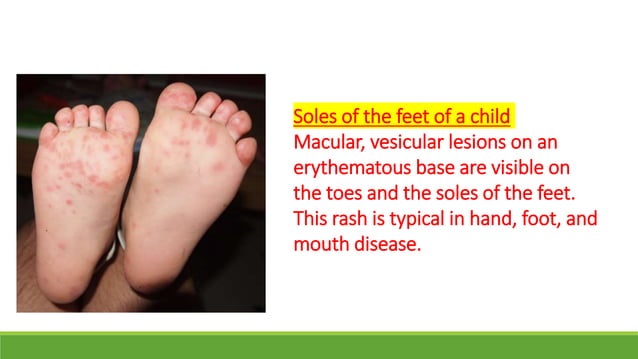 Enteroviruses ( Coxsackie & Echoviruses) | PPT