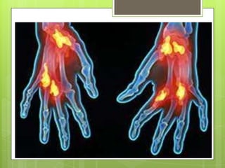 Entesitis | PPTX