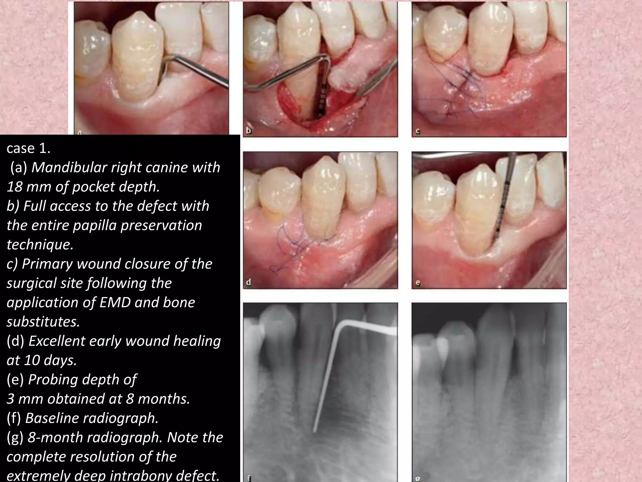 Entire papilla preservation technique | PPTX