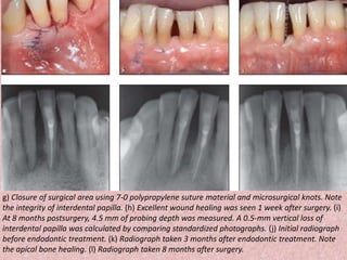 Entire papilla preservation technique | PPTX
