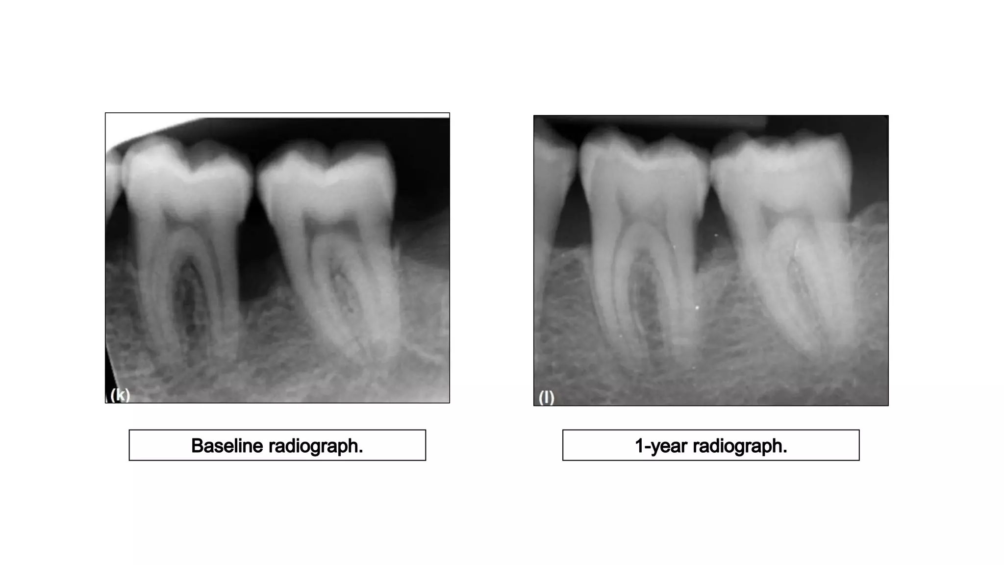 Entire papilla preservation technique in the regenerative treatment of ...