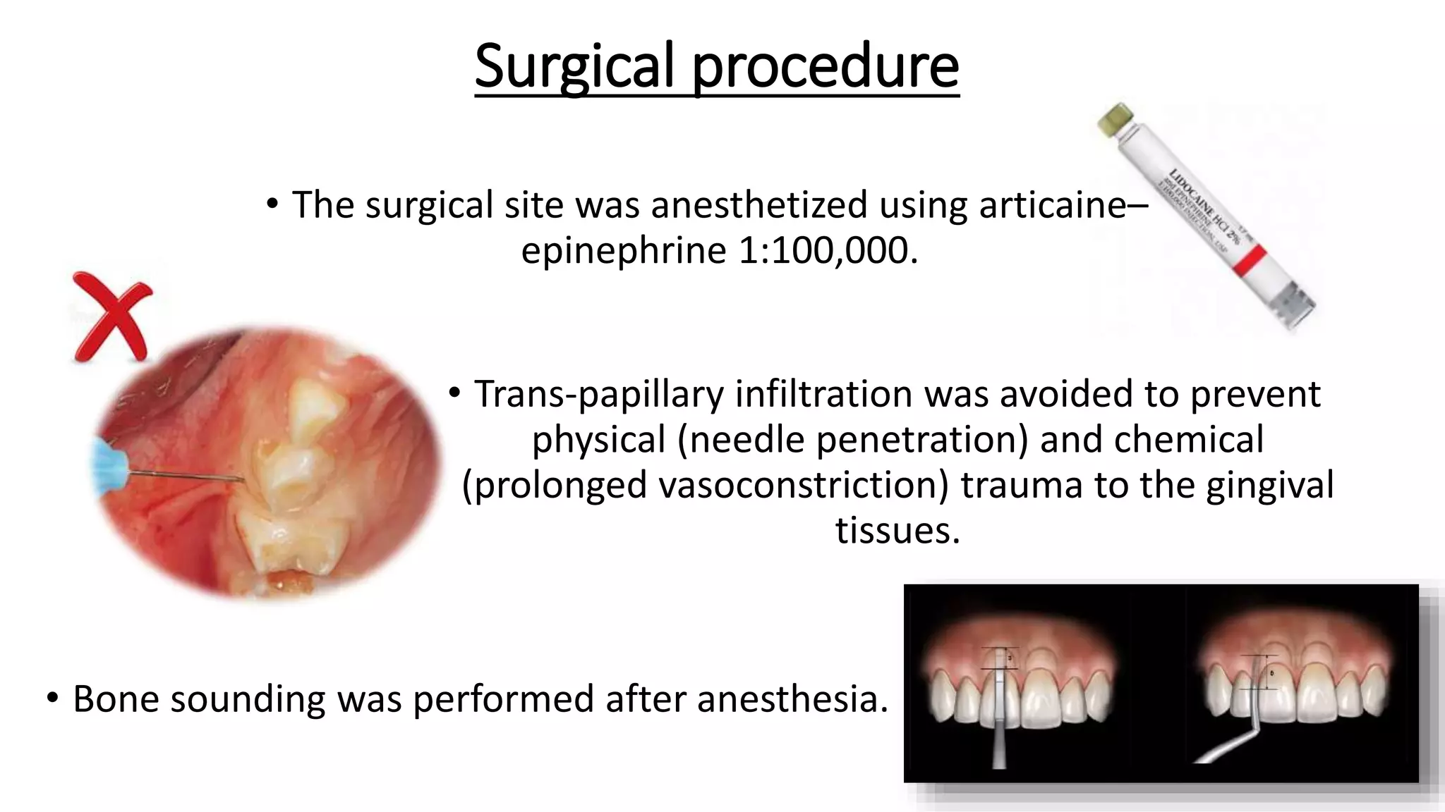 Entire papilla preservation technique in the regenerative treatment of ...