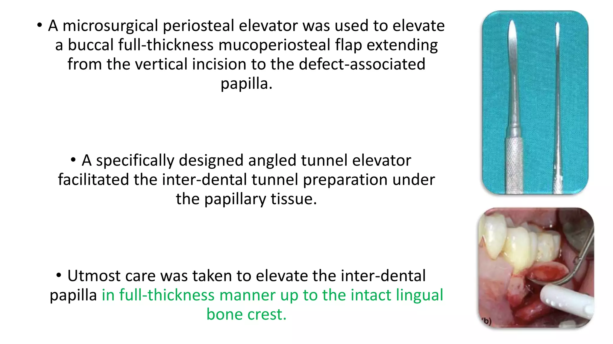 Entire papilla preservation technique in the regenerative treatment of ...