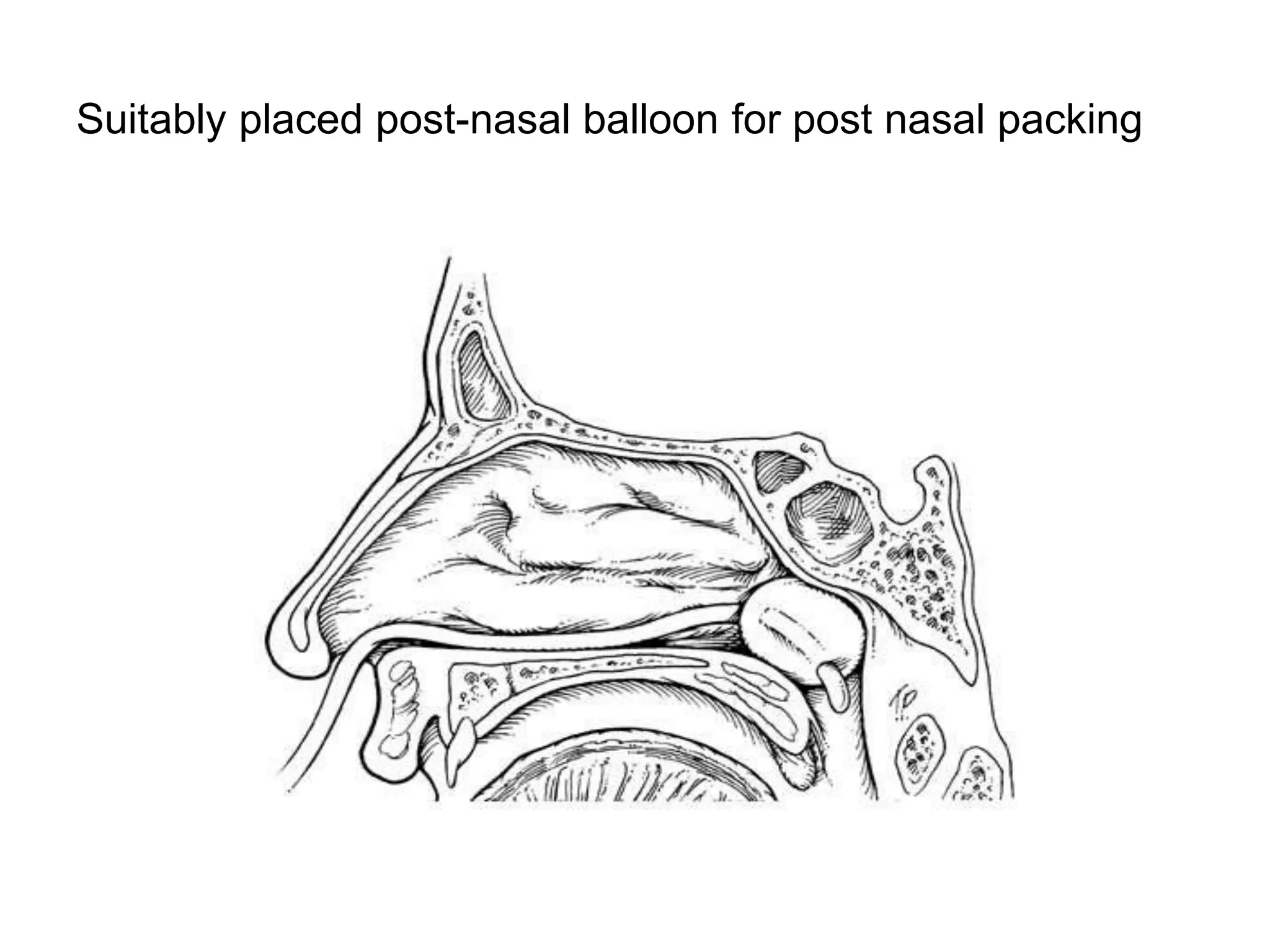ENT NASAL.ppt