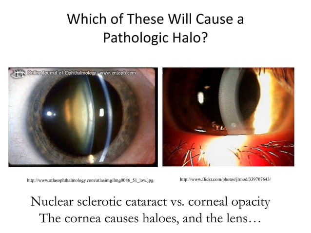 Entoptic phenomena | PDF | Eye and Vision Conditions | Diseases and ...