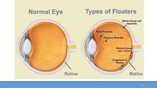 Entoptic phenomena | PDF