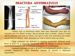 Entorse,luxatii, fracturi | PPTX