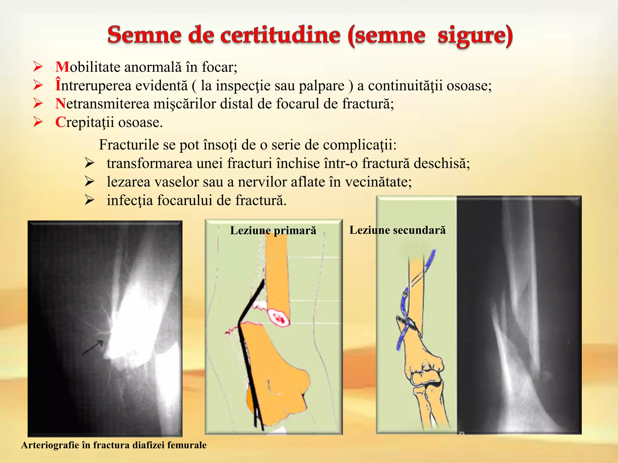 Entorse, luxatii, fracturi | PDF