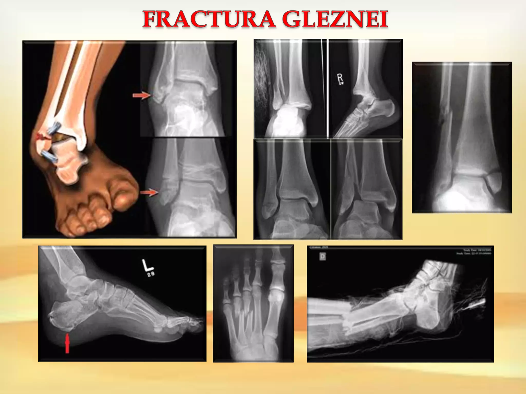 Entorse, luxatii, fracturi | PDF