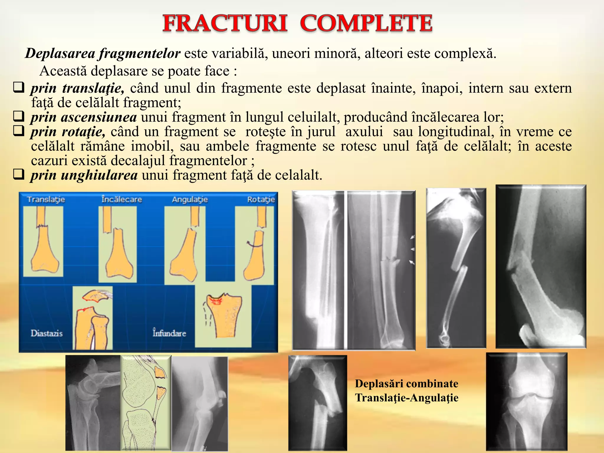 Entorse, luxatii, fracturi | PDF