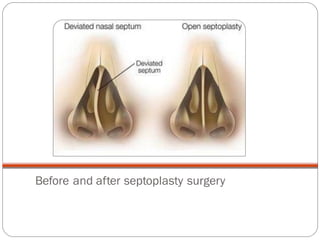 septoplasty and smr | PDF