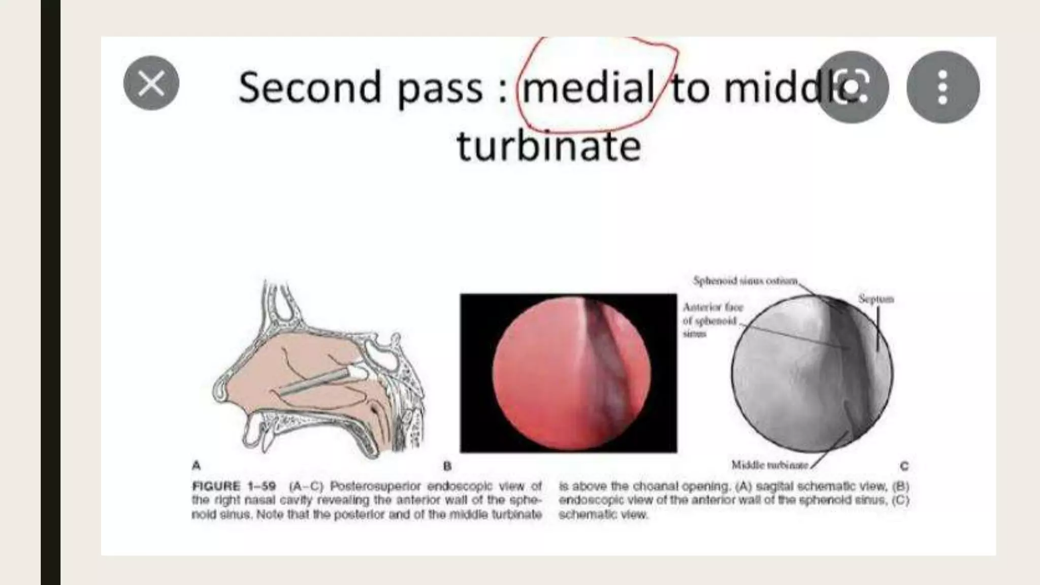 diagnostic nasal endoscopy | PPTX