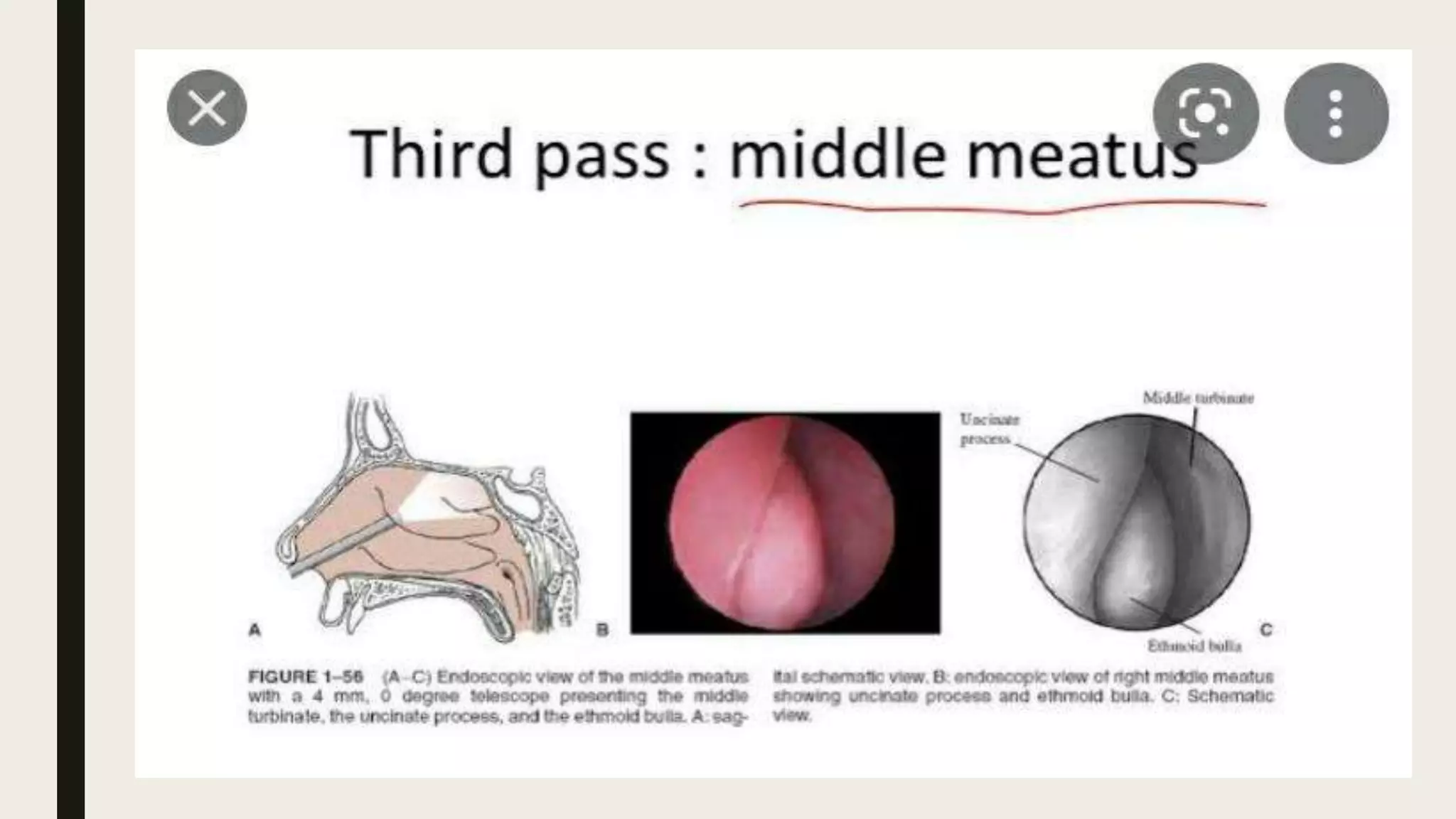 diagnostic nasal endoscopy | PPTX