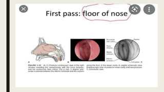 diagnostic nasal endoscopy | PPTX