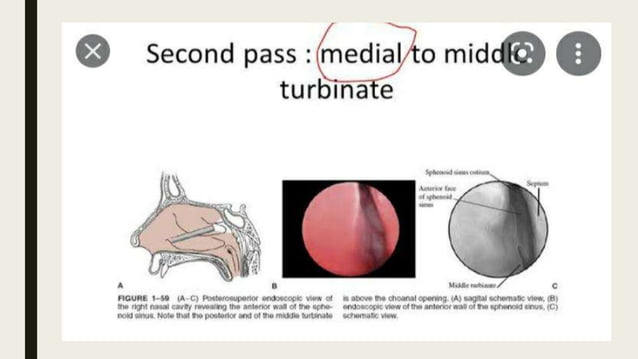 diagnostic nasal endoscopy | PPTX