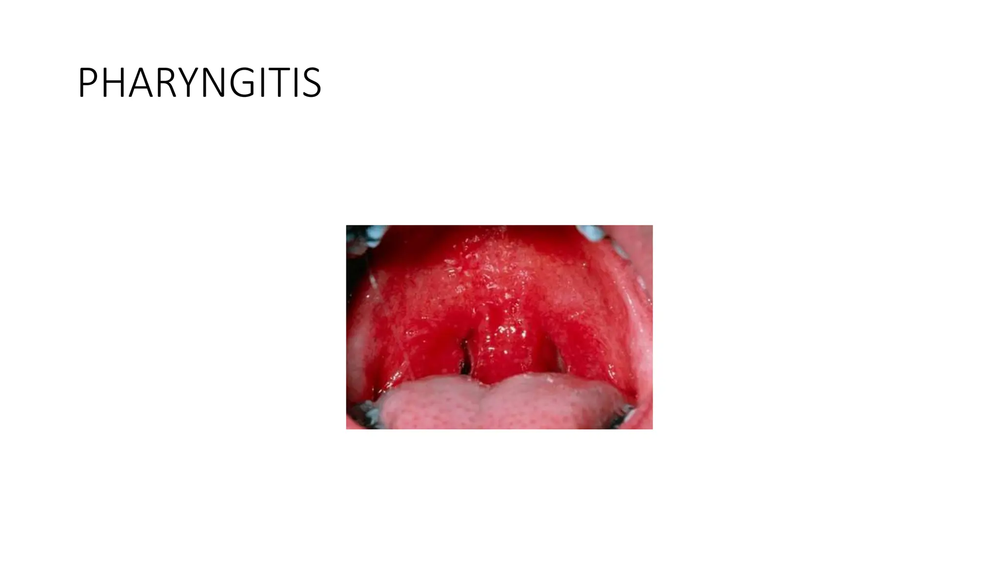 ENT PROBLEMS IN CHILDREN. .pptx