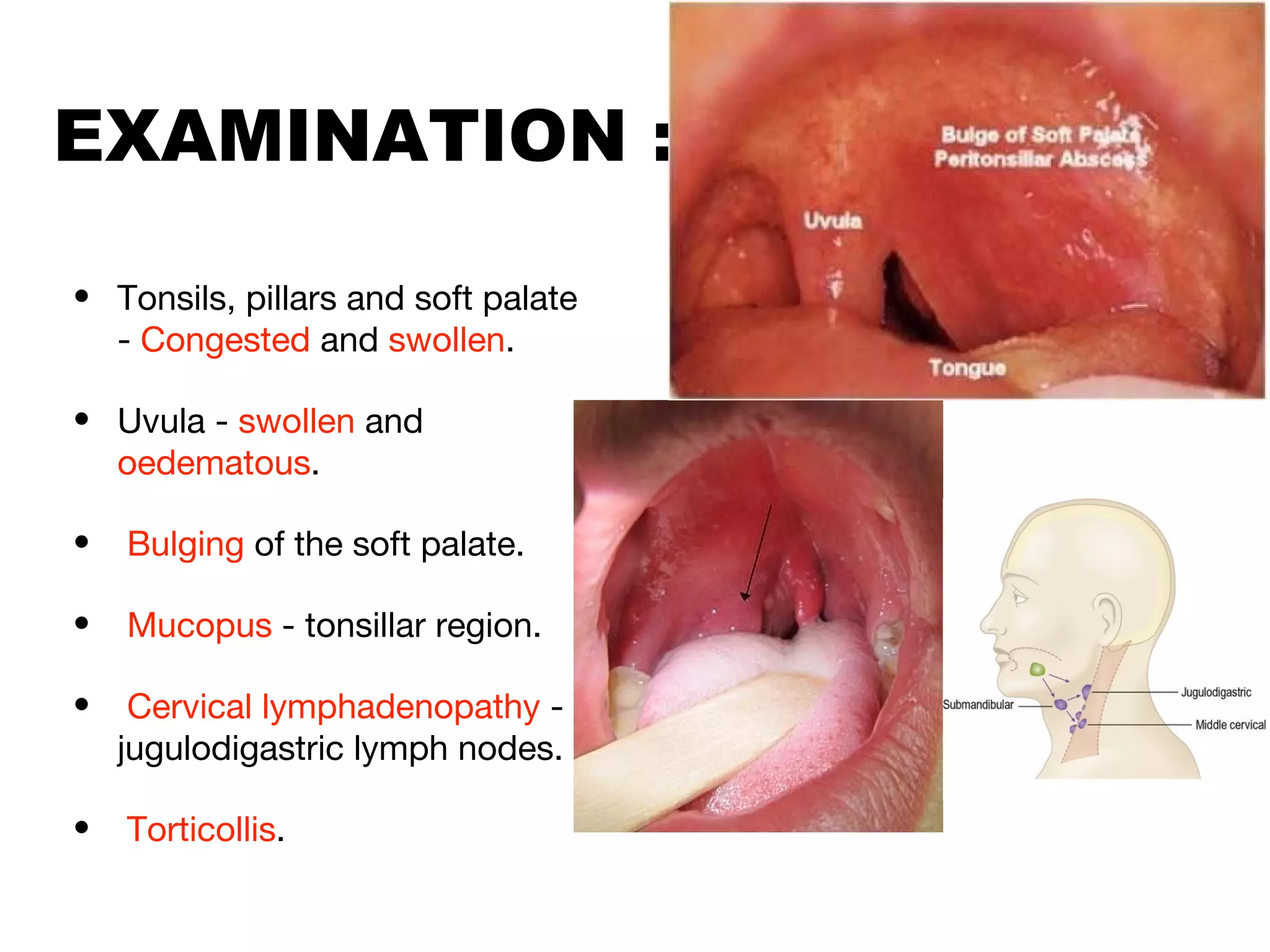QUINSY Peritonsillar Abscess PPT